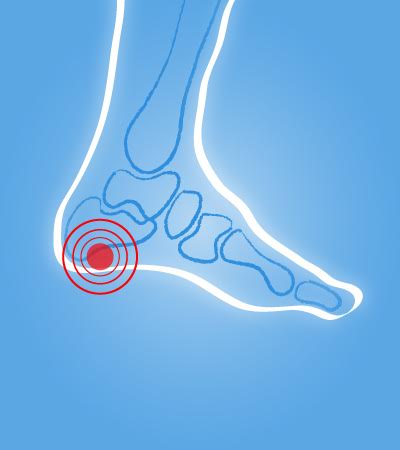 Hielspoor - Orthopedisch Schoenmakerij